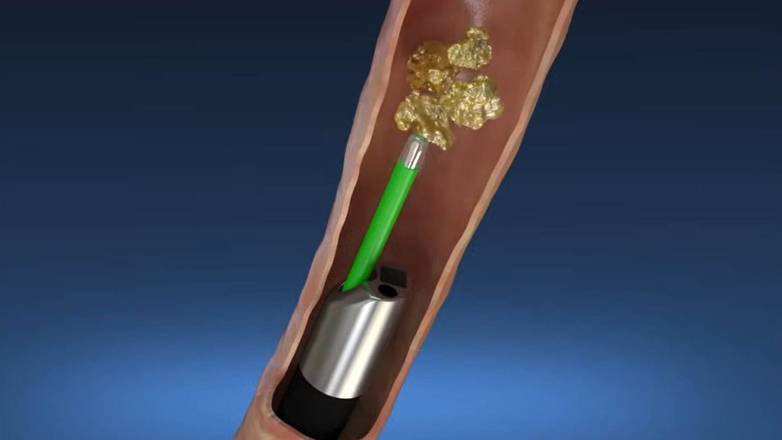 Ureteroscopy (URS): Deteksi Batu Ginjal & Masalah Kemih