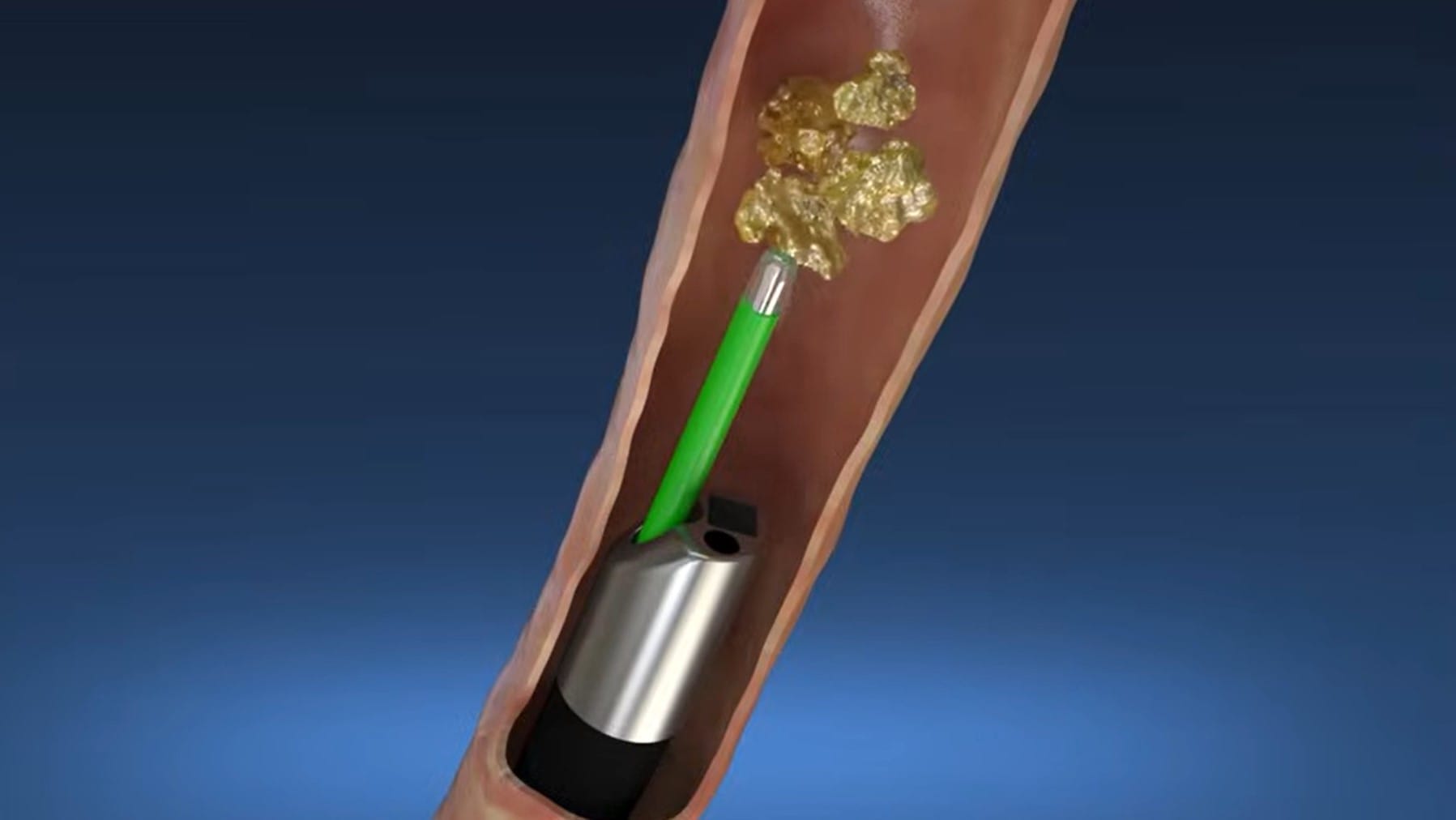 Ureteroscopy (URS): Deteksi Batu Ginjal & Masalah Kemih